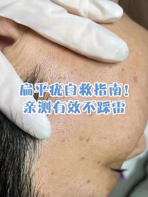 疣怎么治疗图标