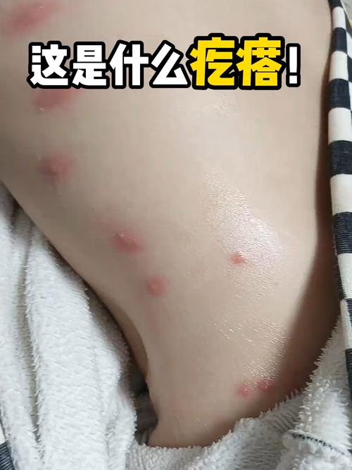 身上痒一挠就起红疙瘩是怎么回事图标