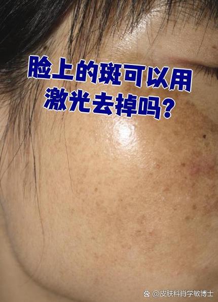 黑斑去除截图