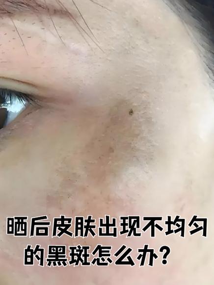 肤色不均匀暗沉怎么改善截图