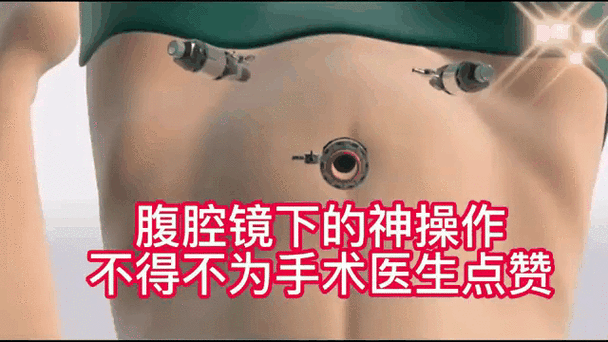 阑尾炎手术演示视频图标