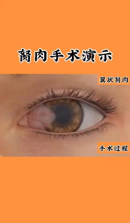胬肉是什么意思截图