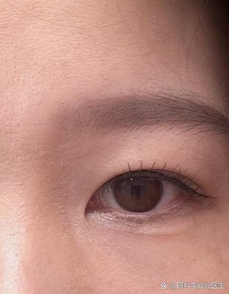 单眼皮突然变内双难受图标