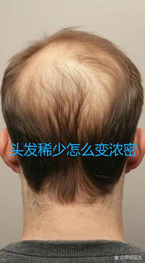 头发稀疏有什么办法让头发变浓密截图