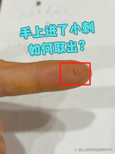 手指扎小刺挑不出来怎么办截图