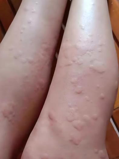 浑身瘙痒起疙瘩是怎么回事图标
