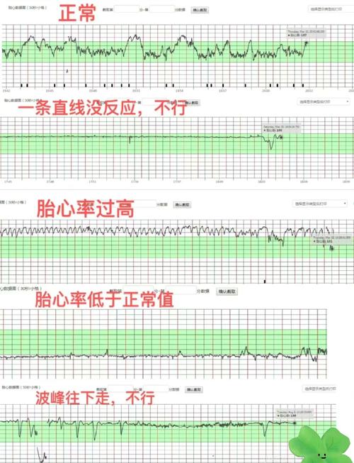 胎心监护cst阴性和阳性图标