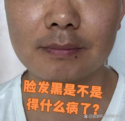面部黑是什么原因图标