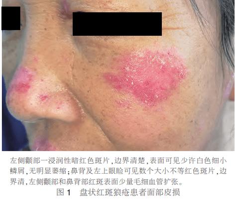 狼疮红斑早期症状图图标