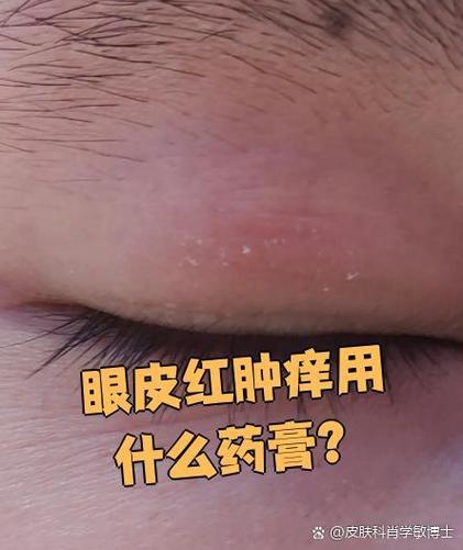 眼睛周围过敏痒红肿抹什么药好图标