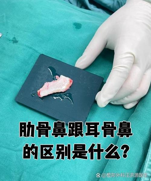 肋骨鼻鼻尖垫筋膜鼓鼓的会吸收吗图标