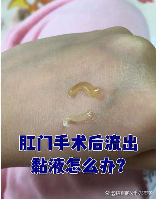 肛门流出粘液有腥臭味图标