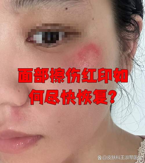 脸上痂皮掉了是红色的图标