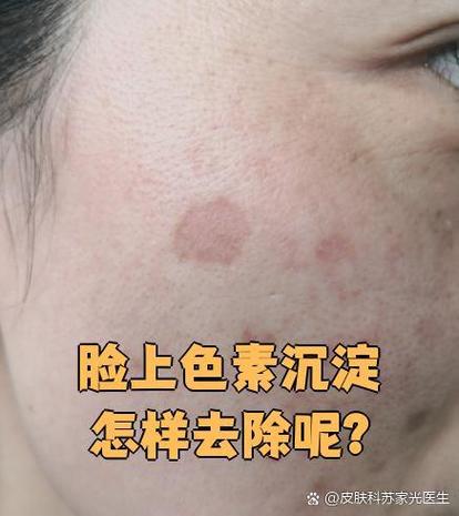 脸上一片黑色素沉淀怎么除掉图片图标