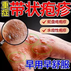 治疗蛇缠腰的特效药图标