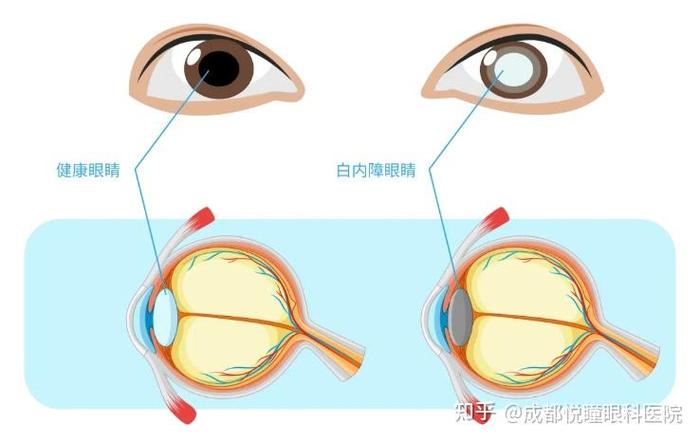 白内障早期怎么治疗最好图标