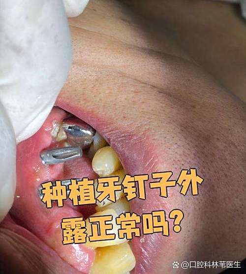 良心医生不建议种植牙的缘由