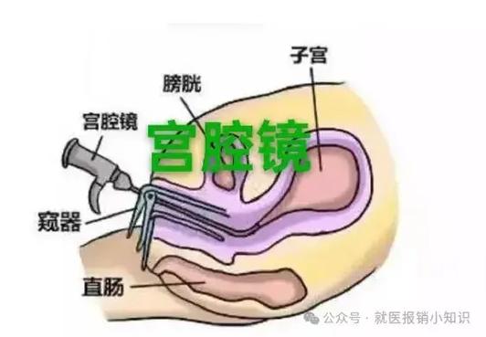 宫腔镜手术和腹腔镜手术的区别图标