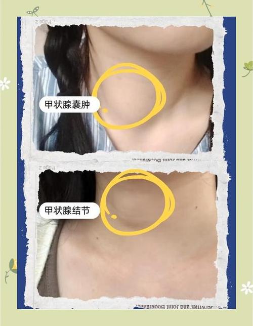 甲状腺图标