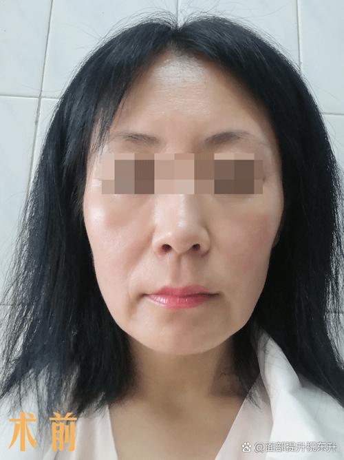 说话的时候没有面部表情怎么改善