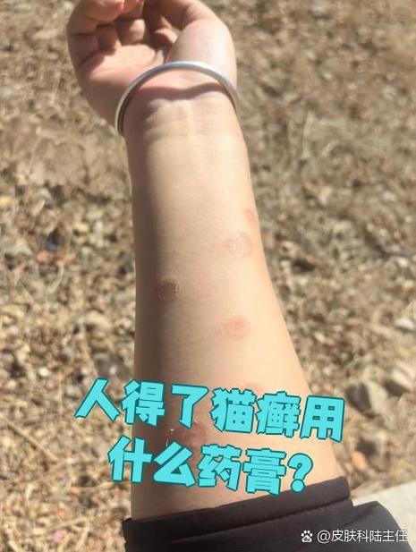 人染了猫藓涂什么药膏截图