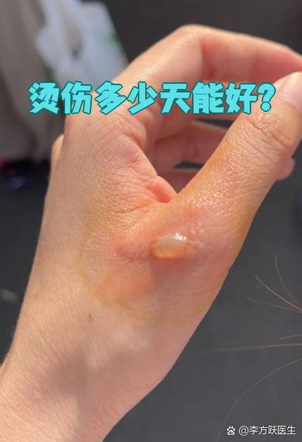 开水烫伤皮肤发红多久才能好图标