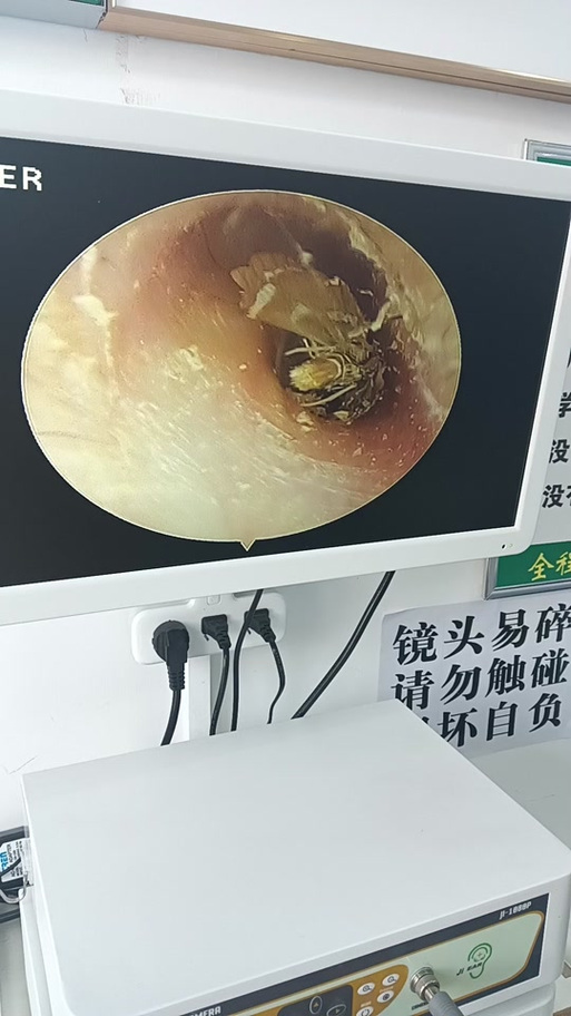 耳朵里进虫的6个迹象图标