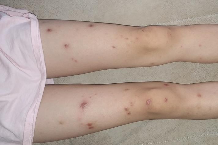 大腿内侧梅毒疹图片图标