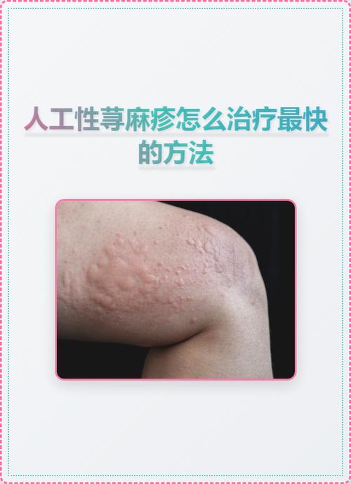 得了荨麻疹怎么治疗截图