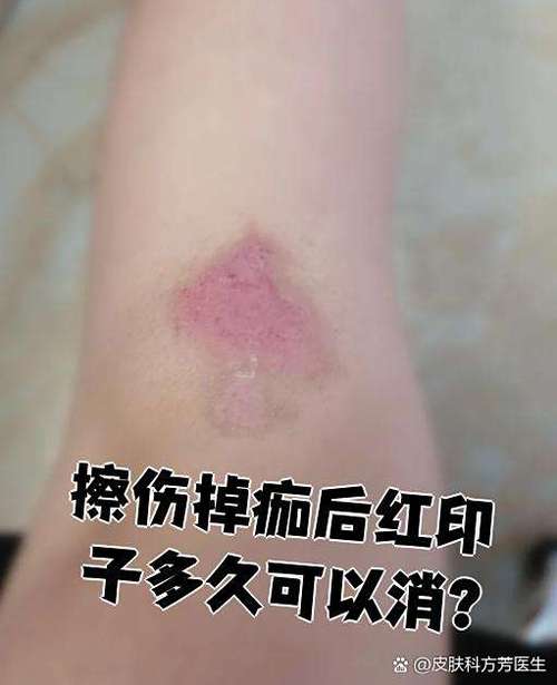 烫伤后红印如何修复截图