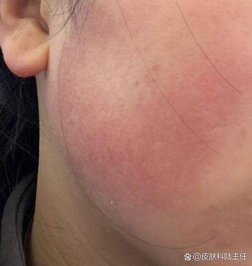 脸上一块红红的像癣图标