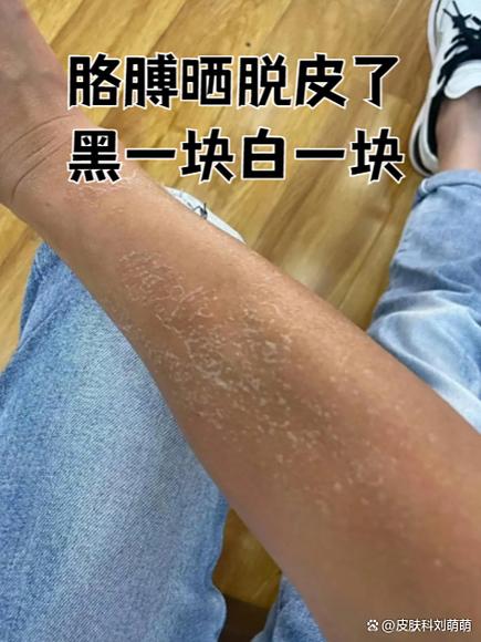 皮肤白一块黑一块是什么原因图标
