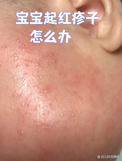新生儿热疹怎么快速消除截图