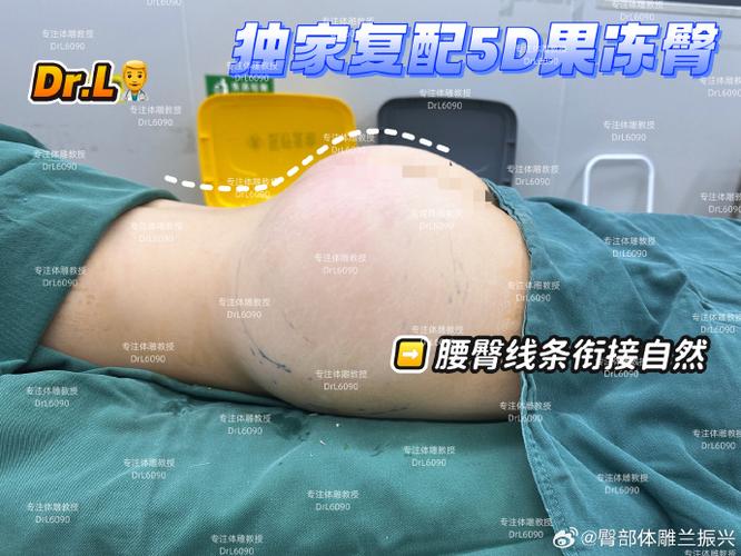 玻尿酸可以丰臀吗图标
