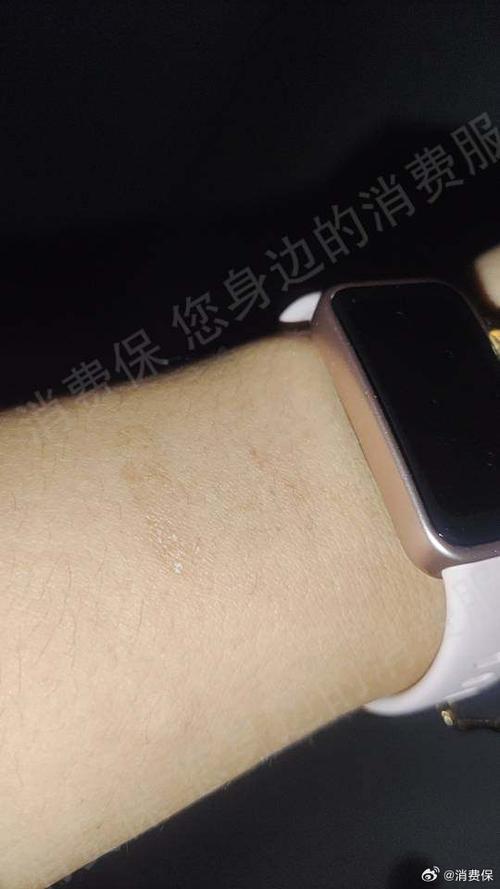 戴手环手掉皮图标