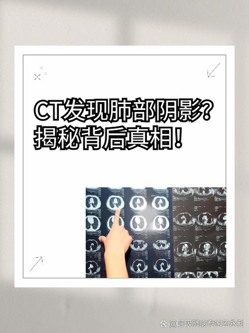 xray是CT检查吗?图标