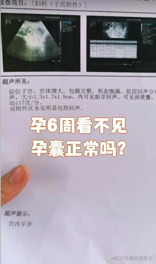 孕6周看不见孕囊有暗区图标