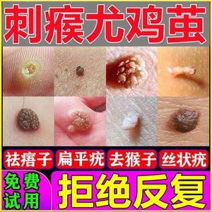 可尤可茧能治疗扁平疣吗截图