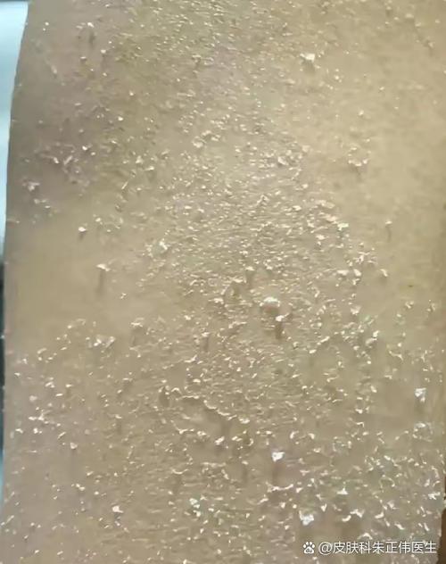 身上脱皮像薄膜一样图标