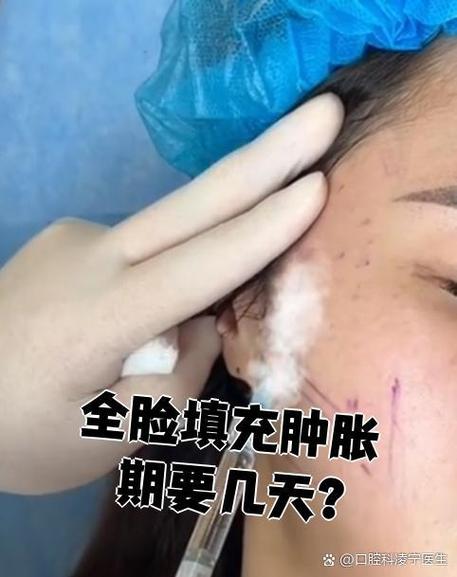 脸被摔了怎么消肿截图
