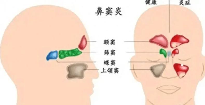 鼻窦炎反复发作怎么回事图标
