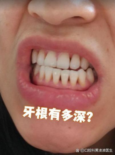 牙齿有牙根还能装牙齿吗图标