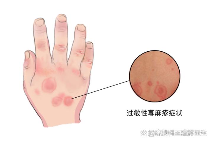 过敏性皮肤病图标