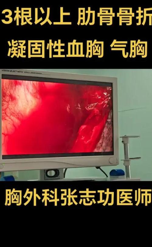 进行性血胸