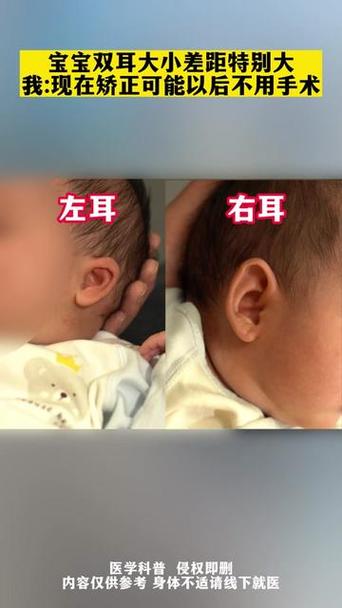耳朵小是什么原因图标