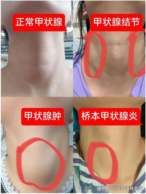 桥本甲状腺炎很普遍吗图标