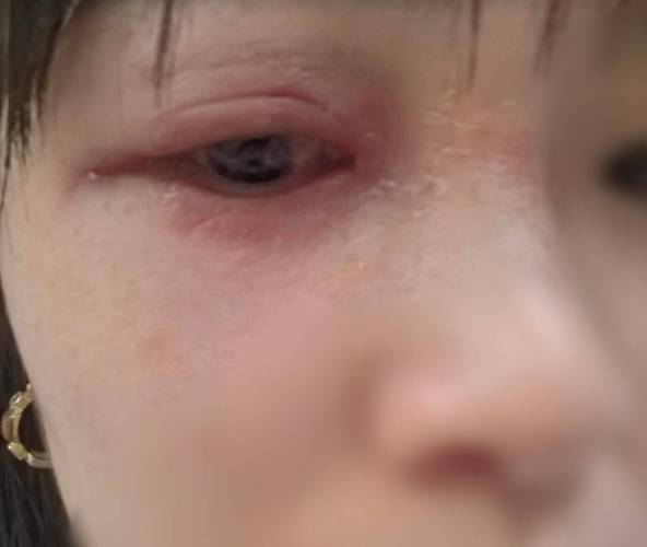 女子拍死隐翅虫眼睛差点瞎了图标