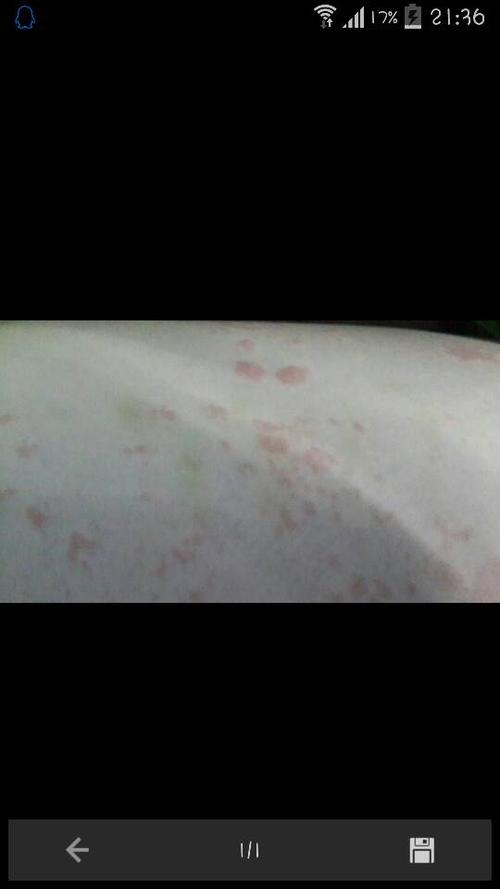 身上起黑色疙瘩特别痒图标