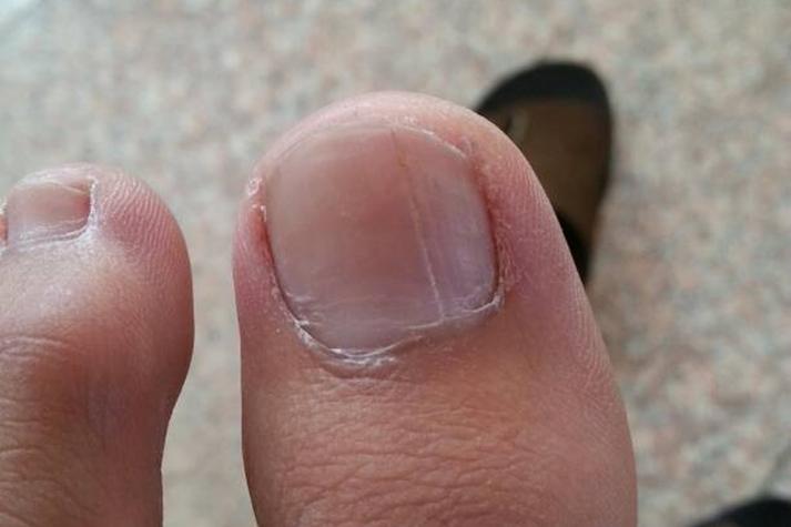 脚指甲长了一条竖线的截图
