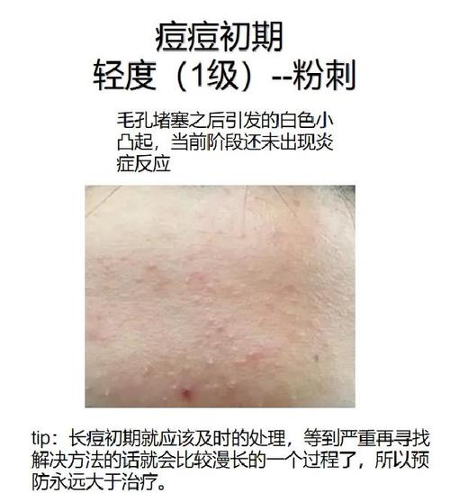 红点痘痘旁边有一圈白色图标